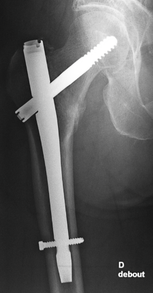 Fractures du col du fémur - Orthopedie Bordeaux