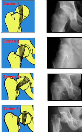 Fractures du col du fémur - Orthopedie Bordeaux